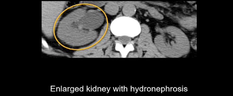 Abdominal CT: renal stones • LITFL • Radiology Library