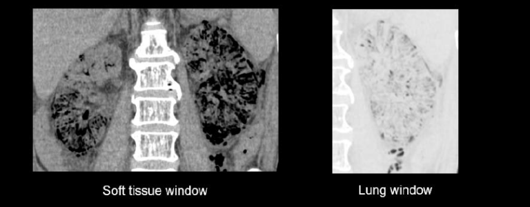 Abdominal CT: renal infections • LITFL • Radiology Library Abdominal CT: renal infections • LITFL • Radiology Library