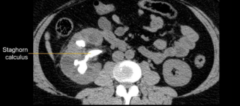 Abdominal CT: renal infections • LITFL • Radiology Library