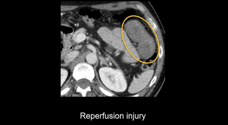 Abdominal CT: intestinal ischaemia • LITFL • Radiology Library