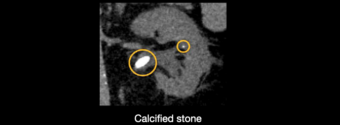 Abdominal CT: renal stones • LITFL • Radiology Library