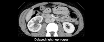 Abdominal CT: renal stones • LITFL • Radiology Library