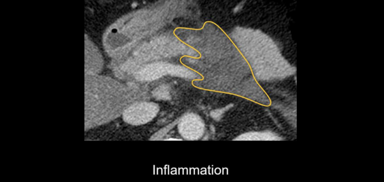 Abdominal CT: interstitial pancreatitis • LITFL • Radiology Library