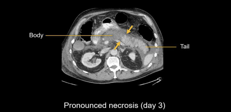 Abdominal CT: necrotizing pancreatitis • LITFL • Radiology Library