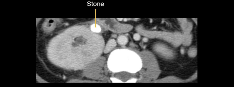 Abdominal CT: renal infections • LITFL • Radiology Library