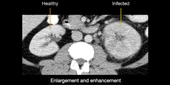 Abdominal CT: renal infections • LITFL • Radiology Library