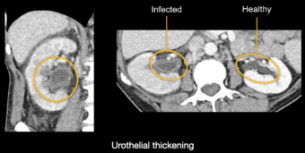 Abdominal CT: renal infections • LITFL • Radiology Library