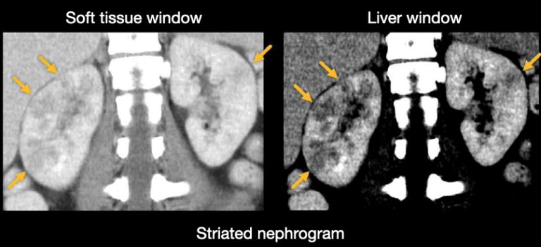 Abdominal Ct Renal Infections • Litfl • Radiology Library