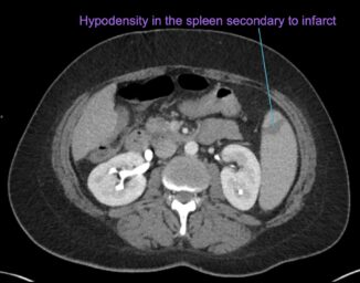 CT Case 056 • LITFL • CT scan interpretation