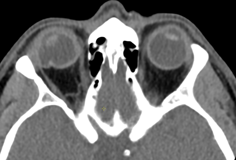 CT Case 020 • LITFL • CT scan interpretation