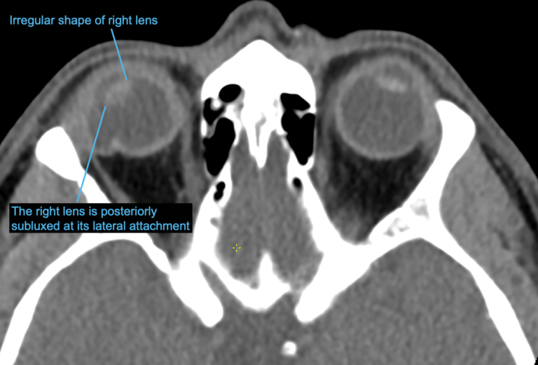 CT Case 020 • LITFL • CT scan interpretation
