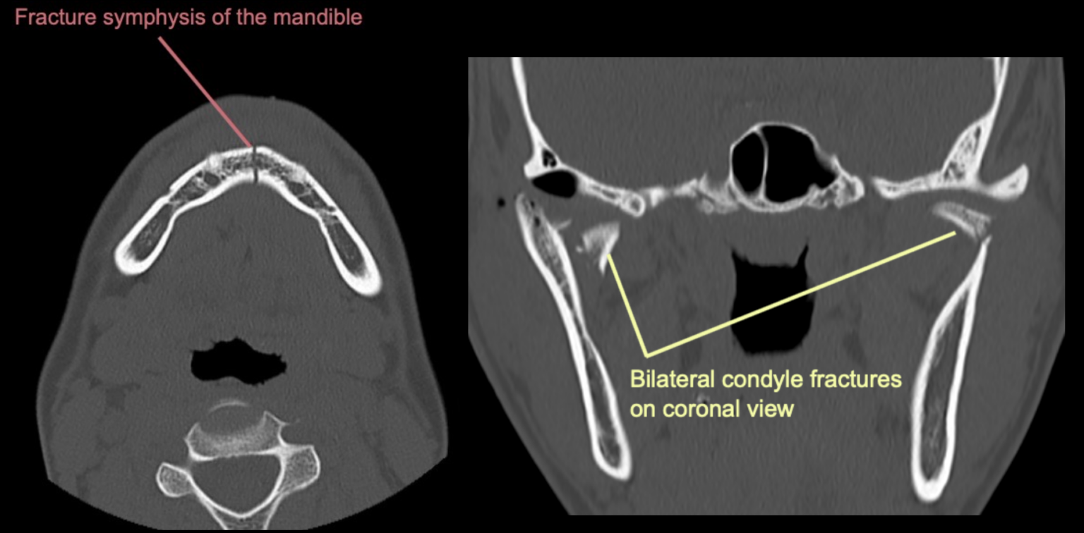 CT Case 021 • LITFL • CT scan interpretation