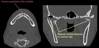CT Case 021 • LITFL • CT scan interpretation