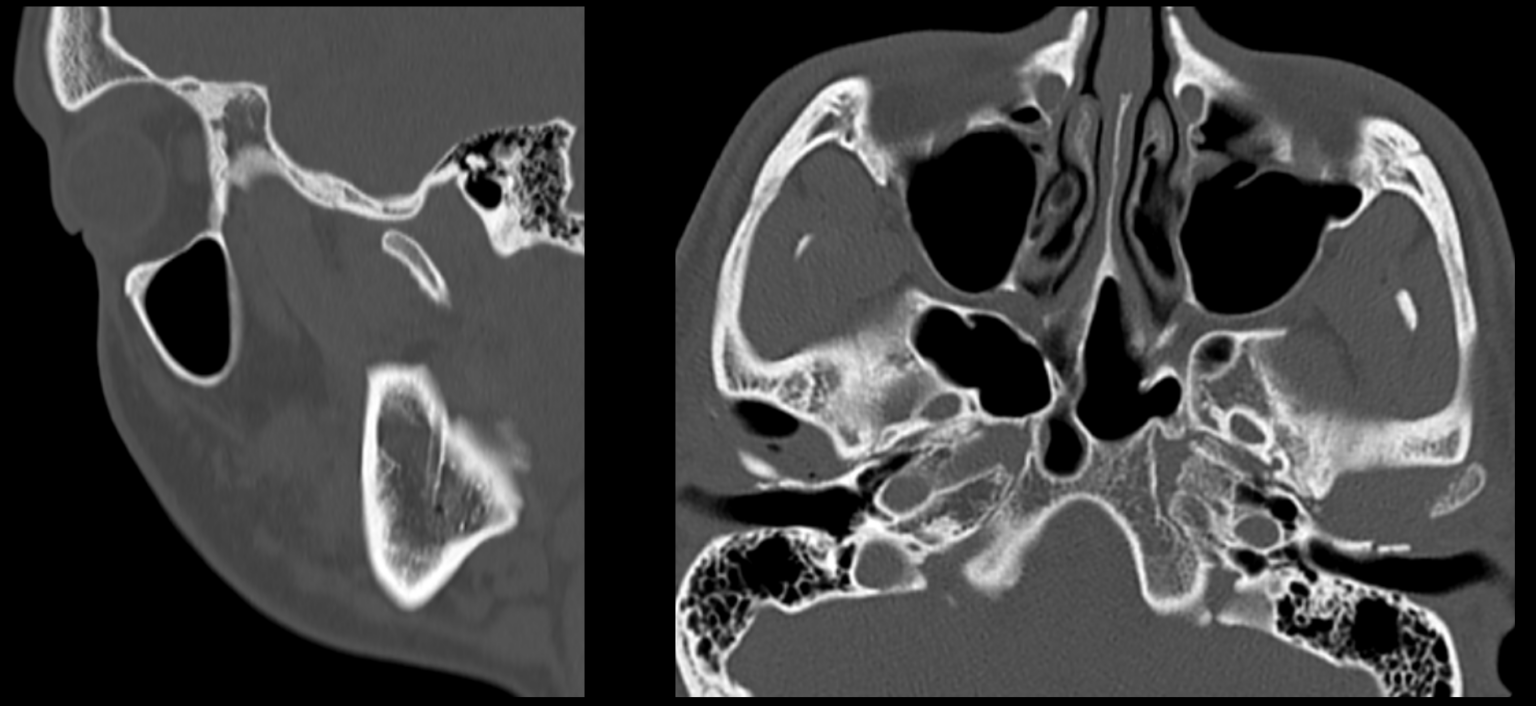 CT Case 021 • LITFL • CT scan interpretation