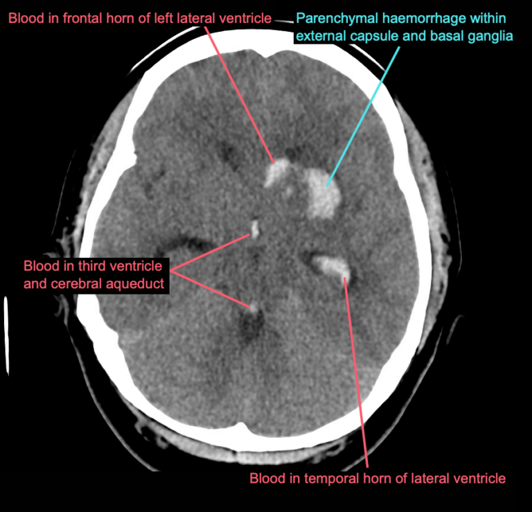 CT Case 022 • LITFL • CT scan interpretation