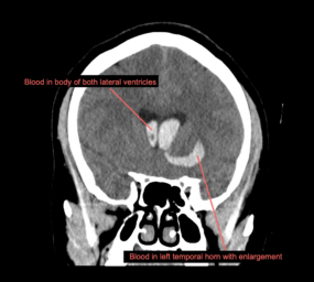 CT Case 022 • LITFL • CT scan interpretation
