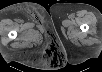 CT Case 023 • LITFL • CT scan interpretation