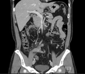CT Case 025 • LITFL • CT scan interpretation
