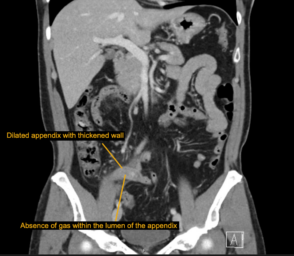 CT Case 025 • LITFL • CT scan interpretation