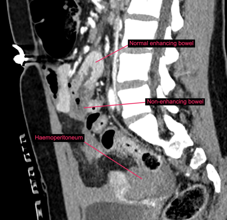 CT Case 026 • LITFL • CT scan interpretation