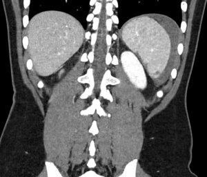 CT Case 026 • LITFL • CT scan interpretation