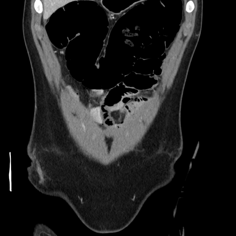 CT Case 026 • LITFL • CT scan interpretation