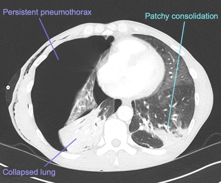 CT Case 029 • LITFL • CT scan interpretation