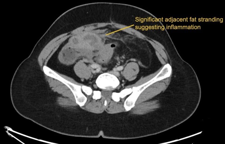 CT Case 024 • LITFL • CT scan interpretation