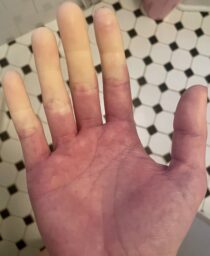 Maurice Raynaud • LITFL • Medical Eponym Library