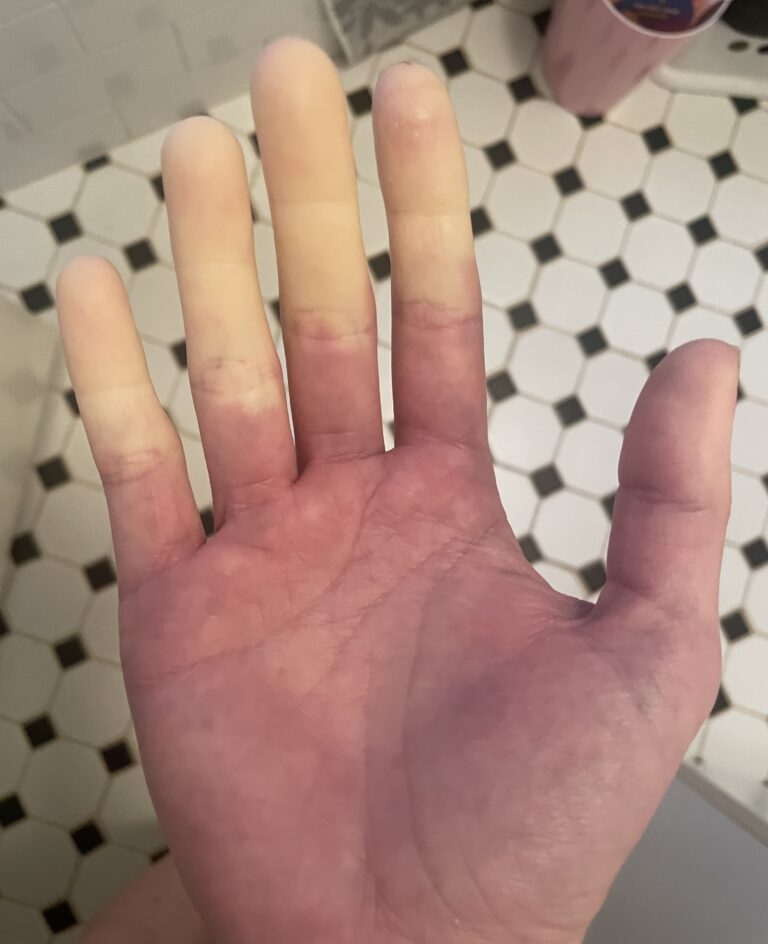 Raynaud phenomenon • LITFL • Medical Eponym Library