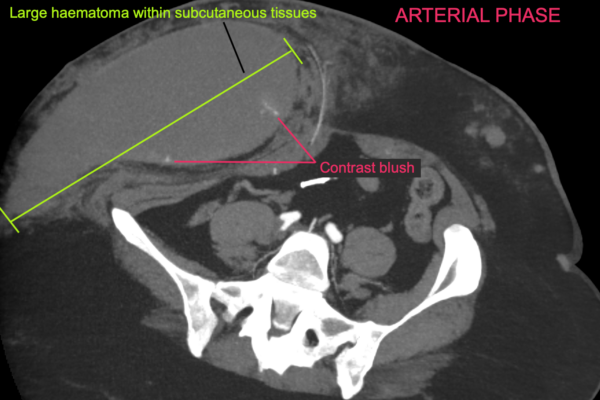 CT Case 031 • LITFL • CT scan interpretation