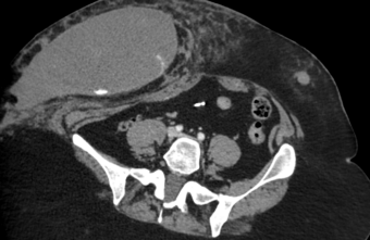 CT Case 031 • LITFL • CT scan interpretation