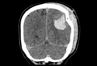 CT Case 032 • LITFL • CT scan interpretation