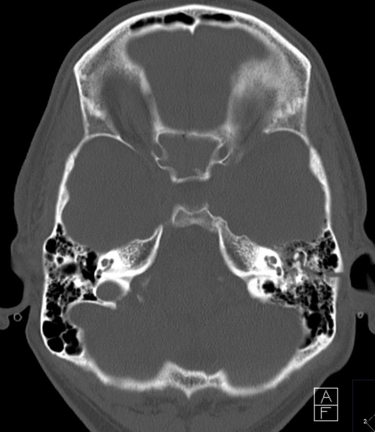 CT Case 032 • LITFL • CT scan interpretation