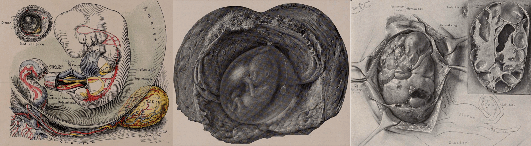 Max Brödel • LITFL • Medical Eponym Library