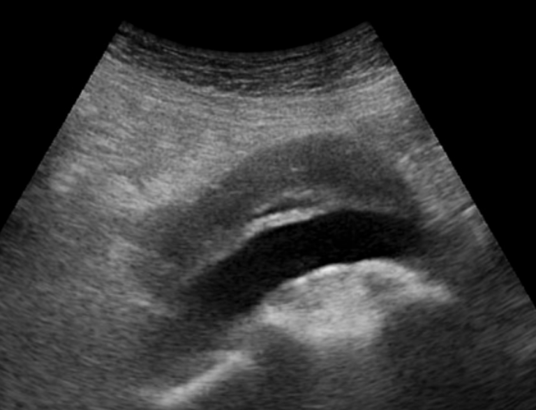 POCUS Made Easy: AAA • LITFL • Ultrasound Library