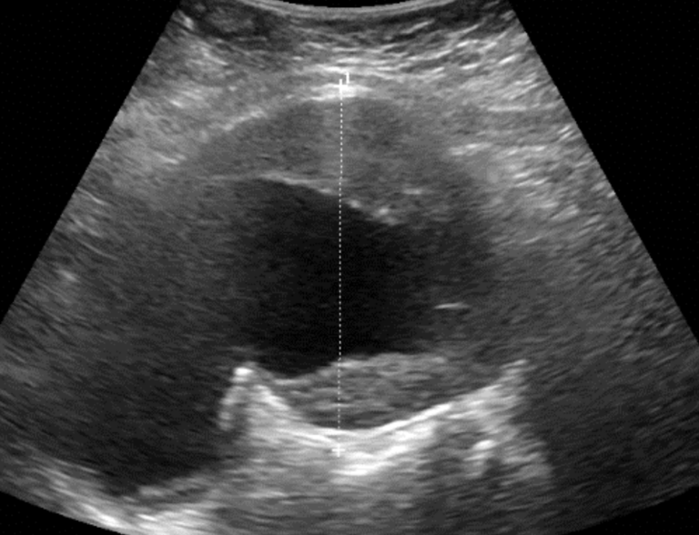 POCUS Made Easy: AAA • LITFL • Ultrasound Library