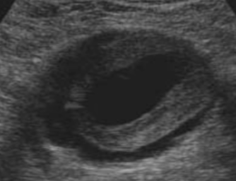 POCUS Made Easy: AAA • LITFL • Ultrasound Library