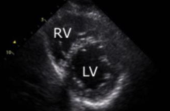 POCUS Made Easy: Basic Echo • LITFL • Ultrasound Library