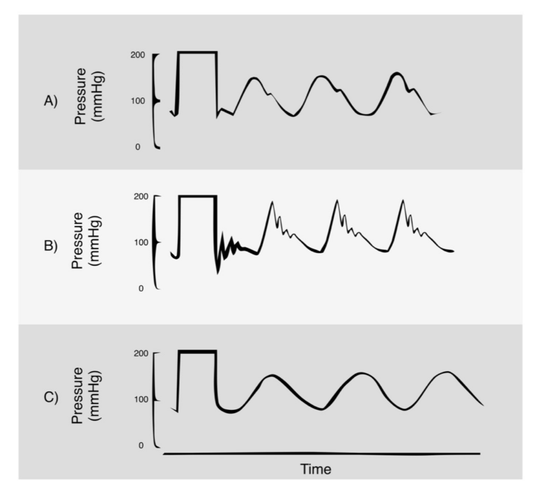 Arterial line and Pressure Transducer • LITFL • CCC Equipment