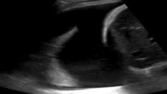 POCUS Made Easy: Lung • LITFL • Ultrasound Library