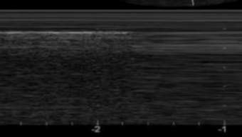 POCUS Made Easy: Lung • LITFL • Ultrasound Library