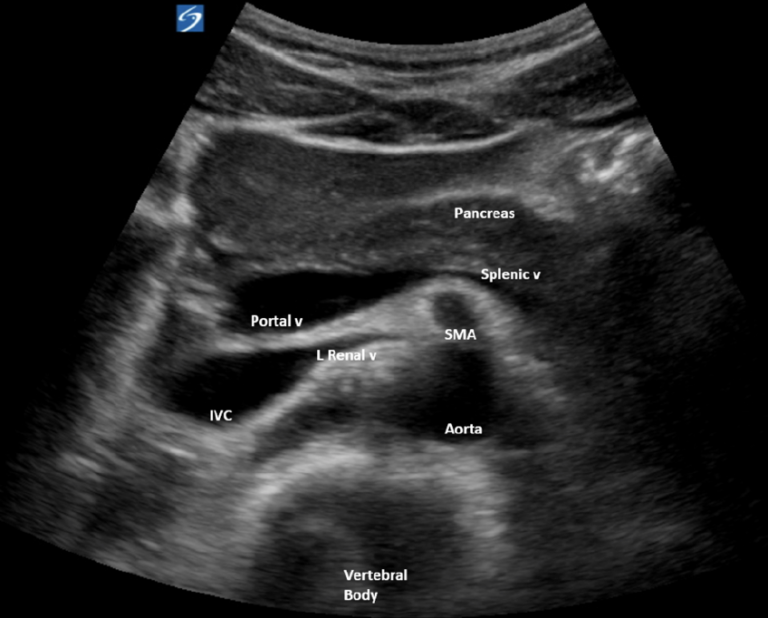 POCUS Made Easy: AAA • LITFL • Ultrasound Library