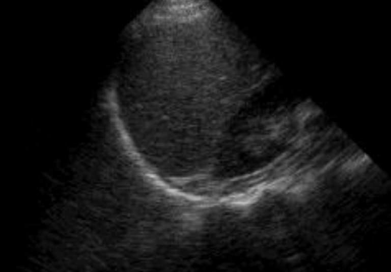 POCUS Made Easy: eFAST • LITFL • Ultrasound Library