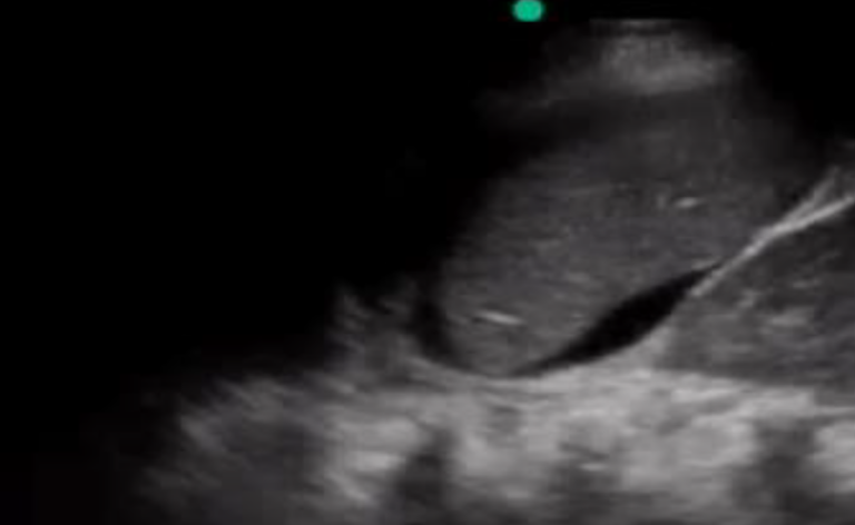 POCUS Made Easy: eFAST • LITFL • Ultrasound Library