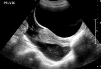 POCUS Made Easy: eFAST • LITFL • Ultrasound Library