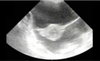 POCUS Made Easy: eFAST • LITFL • Ultrasound Library