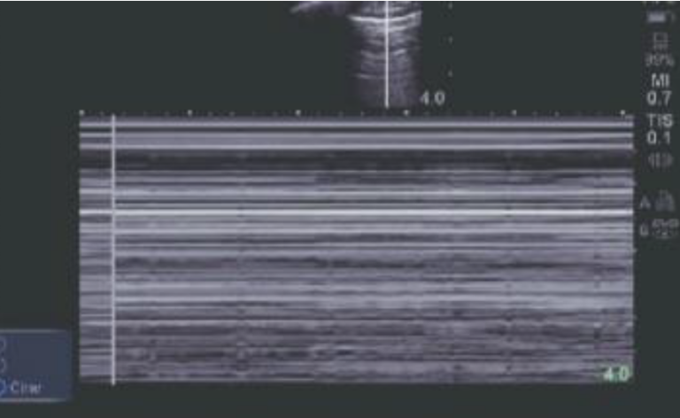 POCUS Made Easy: eFAST • LITFL • Ultrasound Library