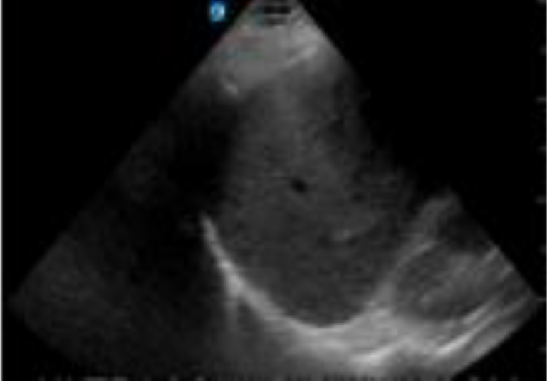 POCUS Made Easy: eFAST • LITFL • Ultrasound Library