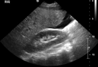 POCUS Made Easy: eFAST • LITFL • Ultrasound Library